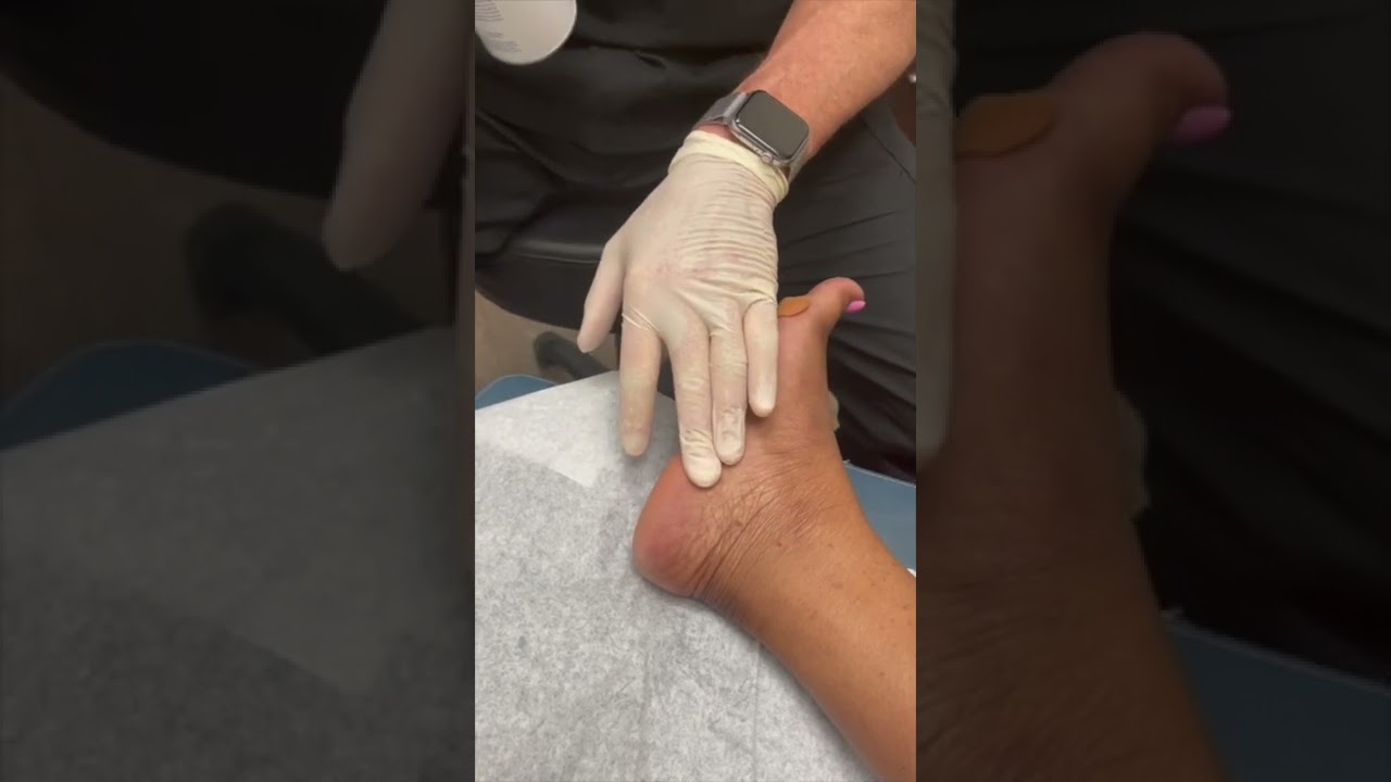 Cortisone Injection for Heel Pain- Dr Moore - YouTube