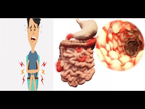 Fezes com muco, o que pode ser? - YouTube