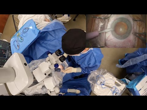Removel of cataract with SEVERE PXF and PHACODONESIS - YouTube