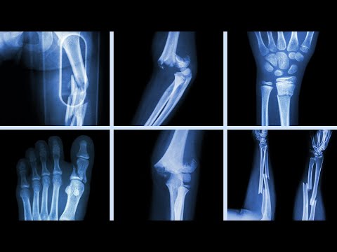 Kırık kaynamaması nasıl tedavi edilir? | Prof. Dr. Yakup YILDIRIM