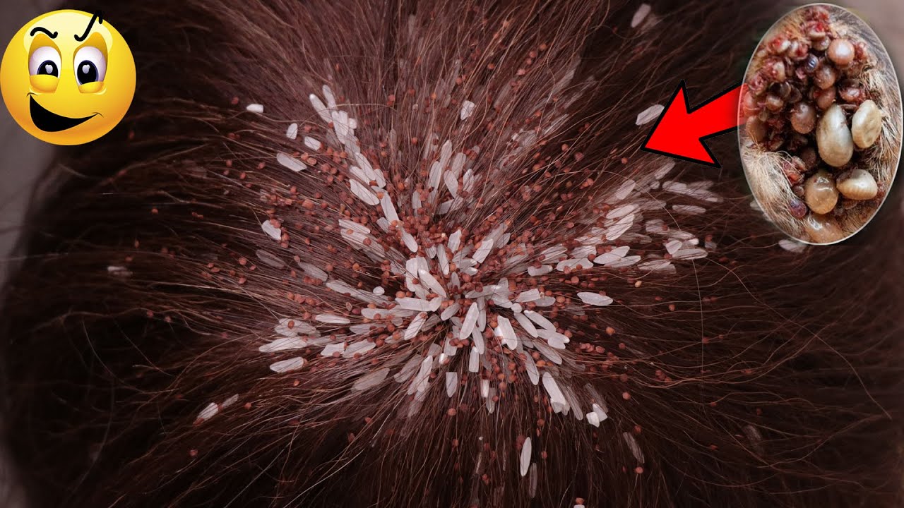 Dandruff Scratching Satisfying Big Worms # 1025 - YouTube