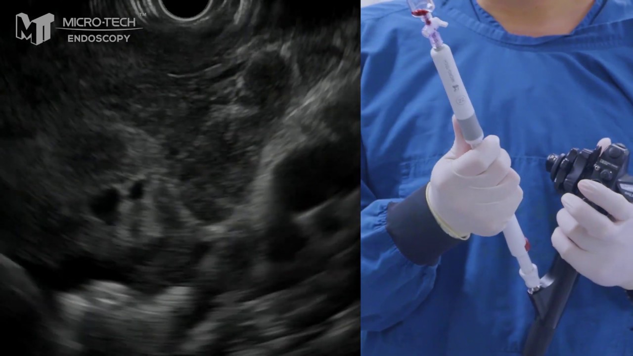 Clinical Application of Trident EUS-FNB Needle - YouTube