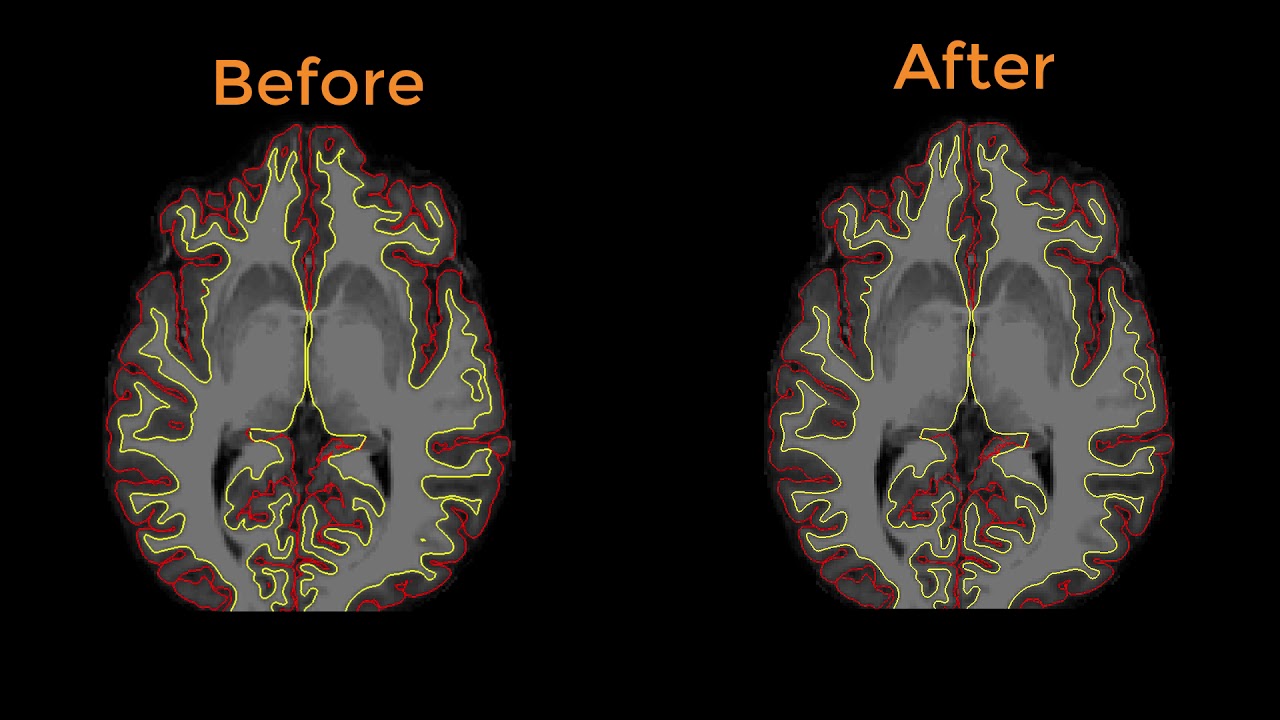 FreeSurfer #14: Intensity Normalization and Control Points - YouTube