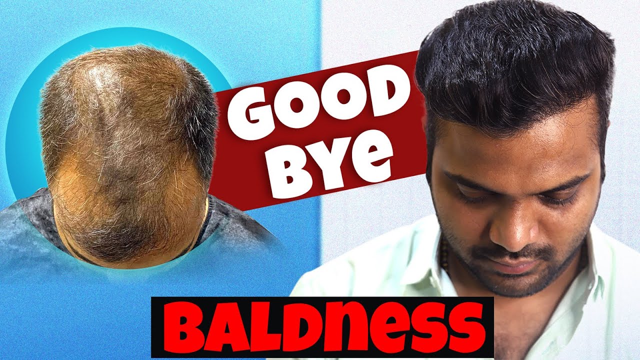 Say Goodbye to Baldness: Hair Transplant in Vashi | New Roots Hair ...