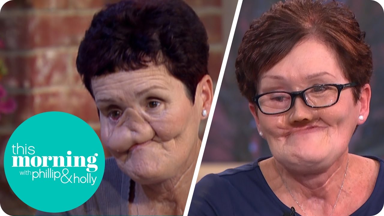 Woman Who Lost Her Nose to Cancer Reveals Her New Face | This Morning ...