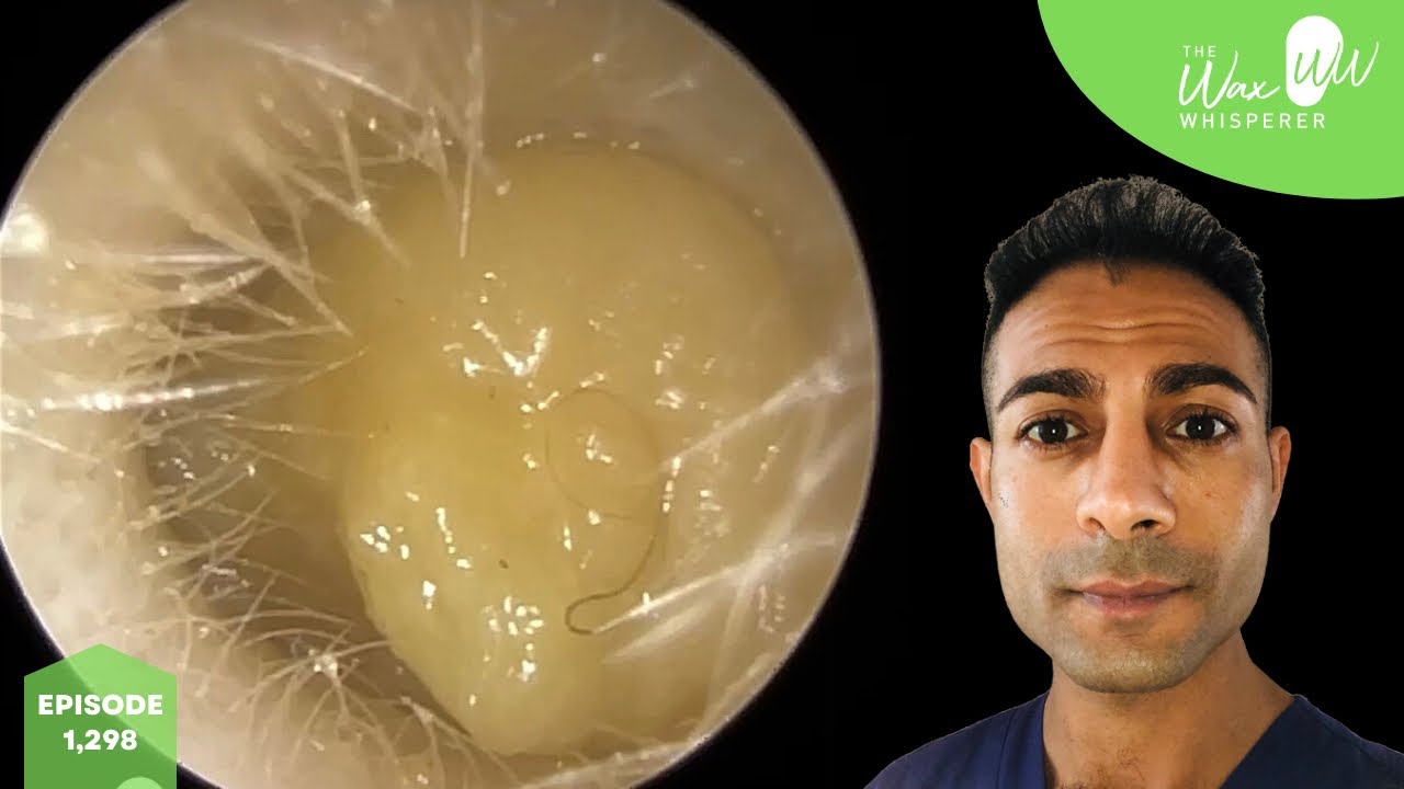 1,298 - Two Cases of Occluding Ear Wax Removal with underlying Middle ...