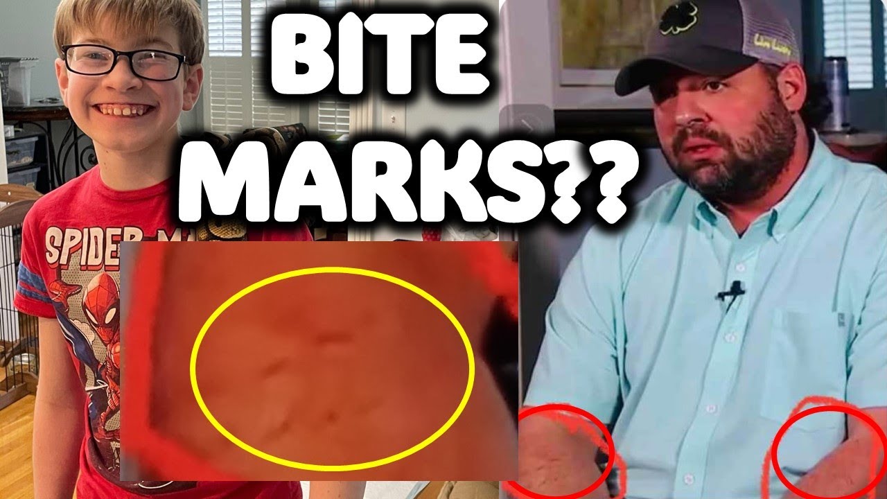 Are Those BITE MARKS on Chris Proudfoot's Arm?! - YouTube