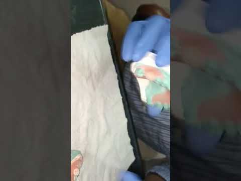 TINA JOHNSON - UPPER FLEXIBLE PARTIAL DENTURE AND LOWER ACRYLIC PARTIAL DENTURE