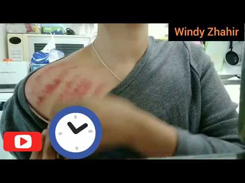 Kerokan DiDada Sampai gosong#kerokan