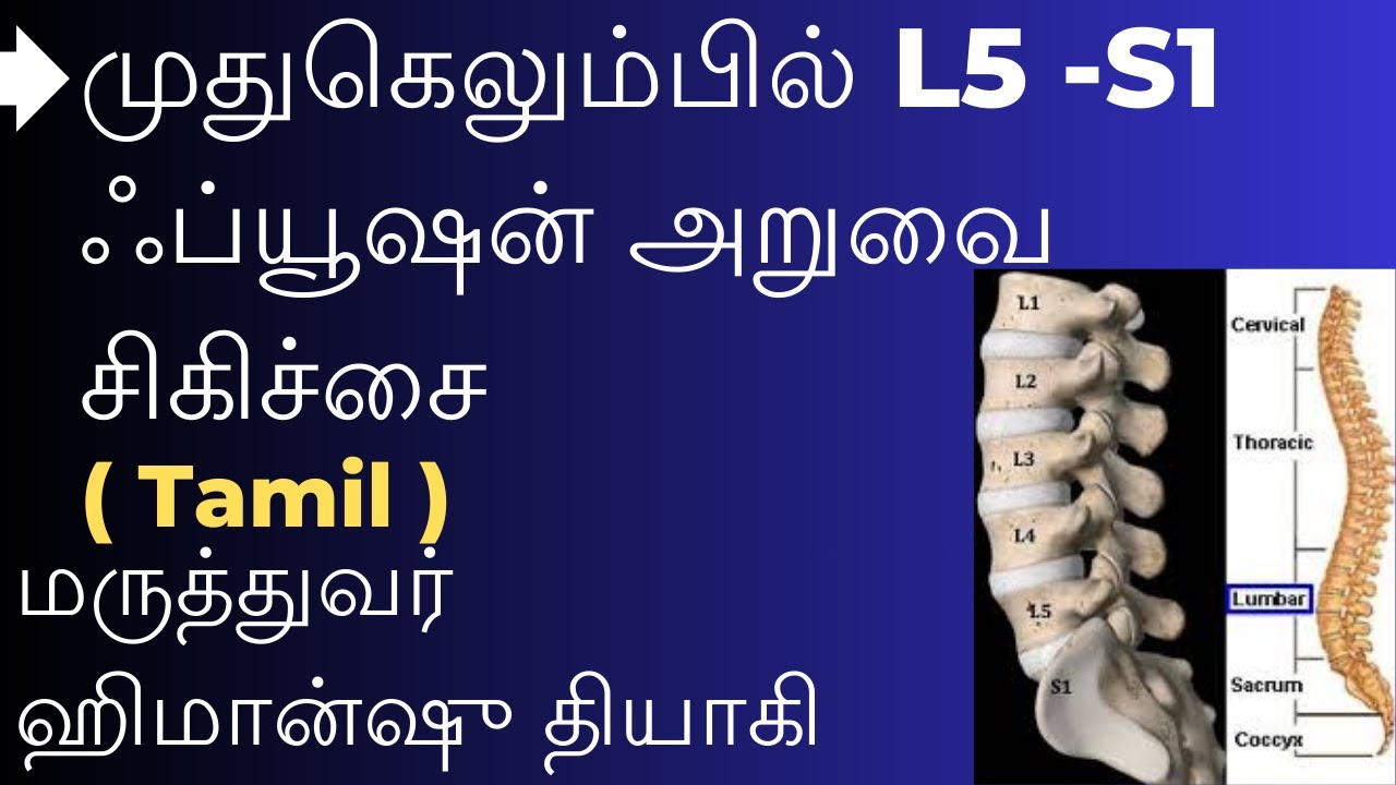 முதுகெலும்பில் L5 -S1 ஃப்யூஷன் அறுவை சிகிச்சை. ( L5 -S1 Fusion Surgery ...