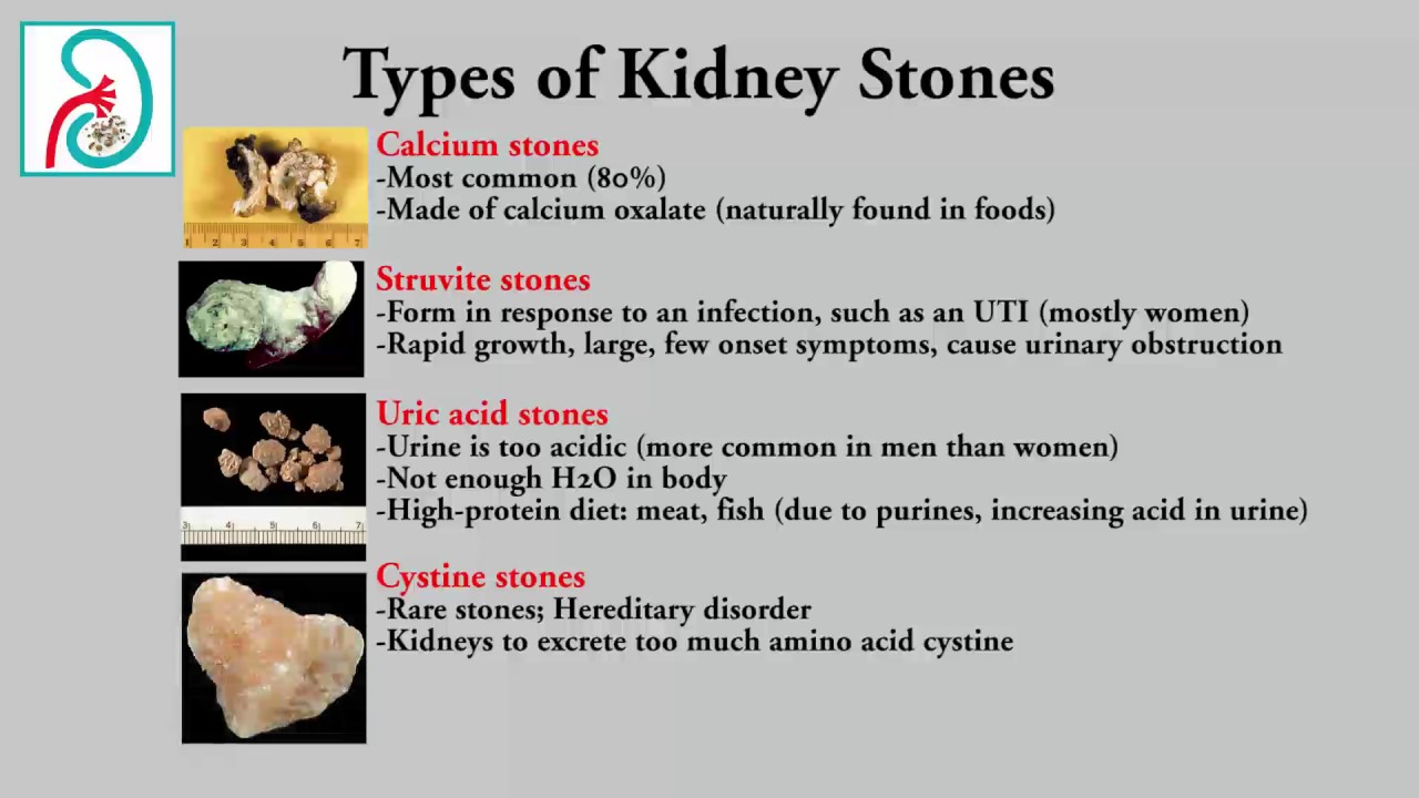 Nephrolithiasis YouTube