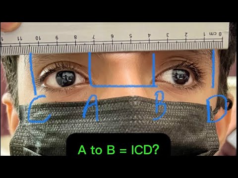 𝗧𝗲𝗹𝗲𝗰𝗮𝗻𝘁𝗵𝘂𝘀 | 𝗛𝘆𝗽𝗲𝗿𝘁𝗲𝗹𝗼𝗿𝗶𝘀𝗺 | 𝗜𝗻𝘁𝗲𝗿𝗰𝗮𝗻𝘁𝗵𝗮𝗹 𝗗𝗶𝘀𝘁𝗮𝗻𝗰e #medical # ...