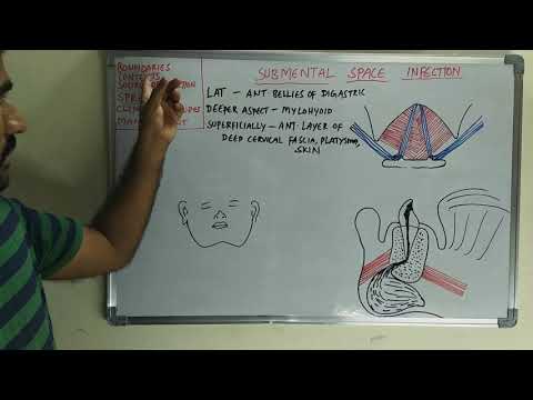 Submental space infection - YouTube