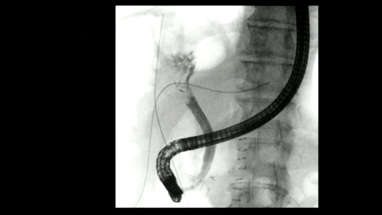EUS-guided rendezvous technique for refractory benign biliary stricture ...