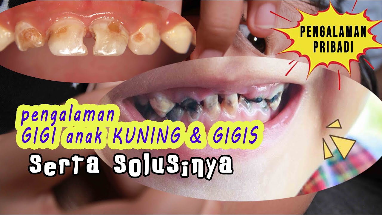 PENYEBAB GIGI GIGIS PADA ANAK | SOLUSI MENGATASI GIGI Kuning & Gigis ...