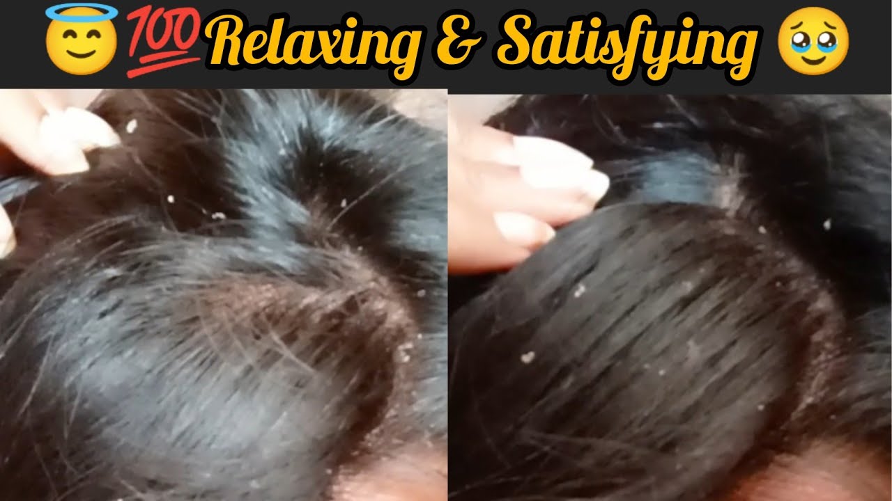 Satisfying dandruff scratching | ASMR | relaxing dandruff removal ...