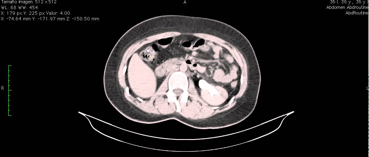 TAC UROTAC - YouTube