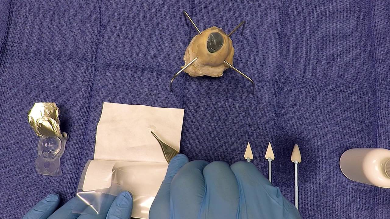 Application of Amniotic Membrane on the Eye - YouTube