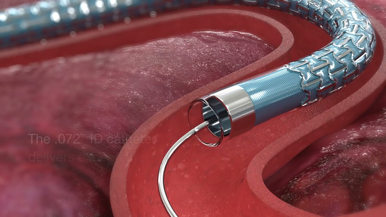 Neurovascular Access Catheter 3D Animation - Infuse Medical - YouTube