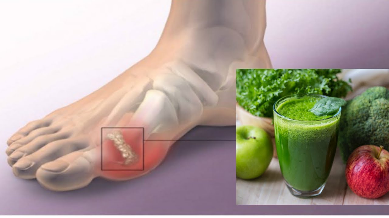 How to Remove Uric Acid Crystals from Your Body to Prevent Joint Pain ...