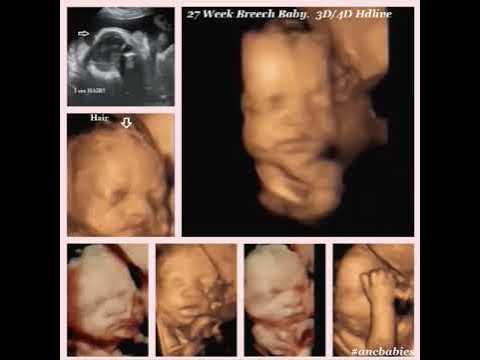 27 Weeks Baby 3D/4D/5D PRIVATE BABY ULTRASOUNDS. PRENATAL ULTRASOUNDS in HANOVER, MA. 781-878 ...
