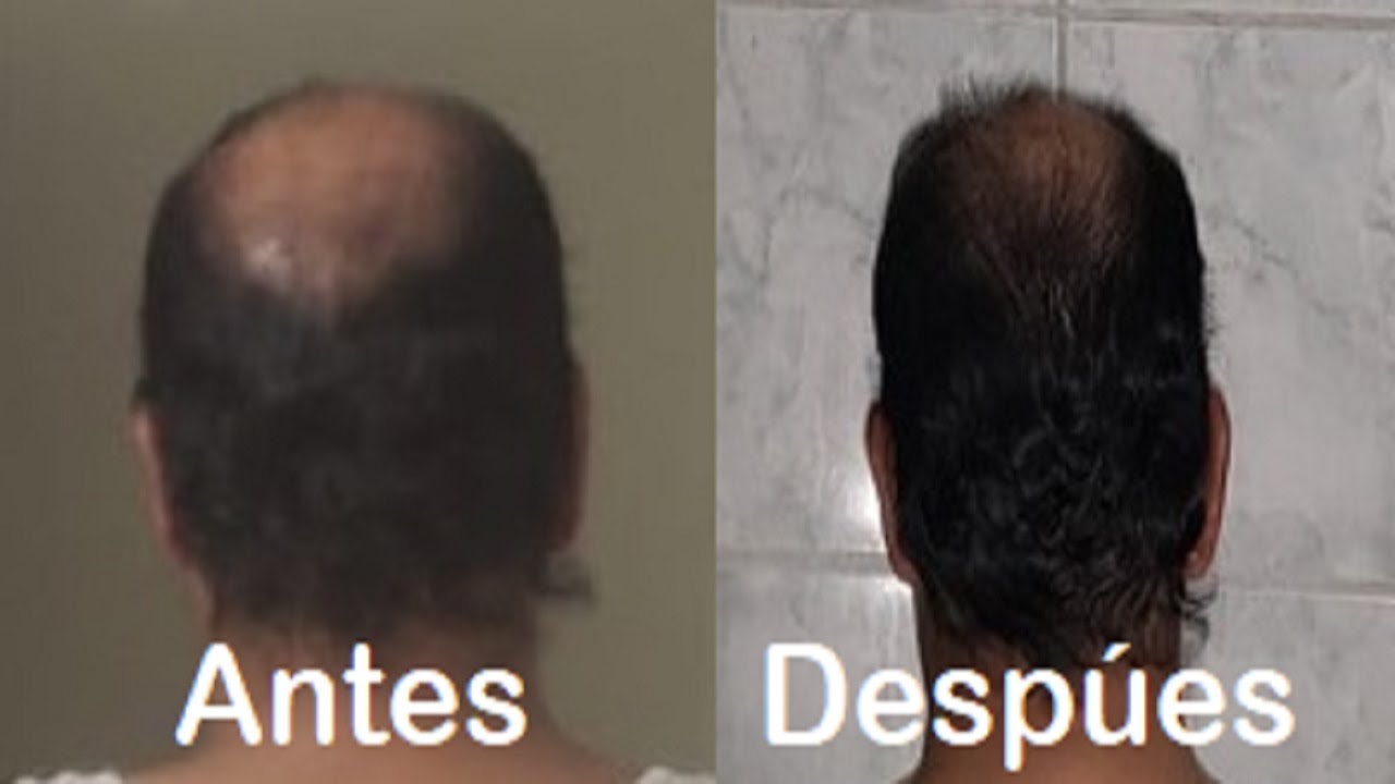 Mira lo que se puso en la coronilla para recuperar su cabello - YouTube