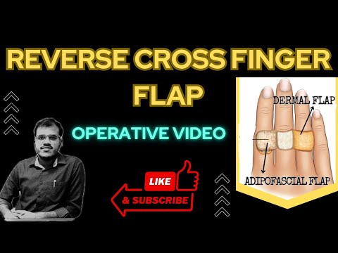 REVERSE CROSS FINGER FLAP COVER - YouTube