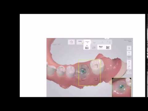 Implant scanning for Trios - YouTube