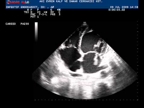 infektif endokardit, mitral vejetasyon, kalp yetersizliği, - YouTube
