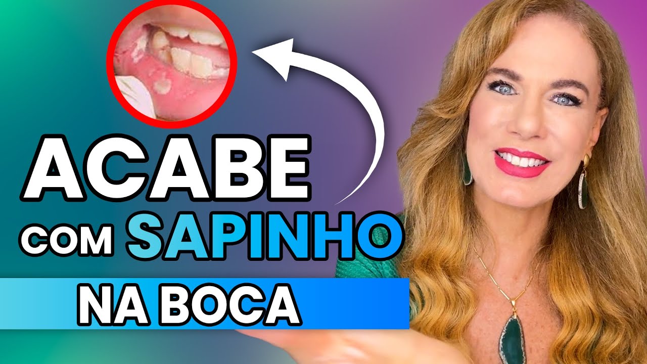 ACABE com a CANDIDIASE ORAL ou SAPINHO na BOCA com 3 DICAS NATURAIS ...