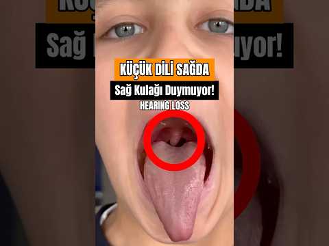 Küçük Dili SAĞA YÖNELMİŞ! İşitme Kaybı da SAĞ TARAFTA! | Atlas Terapi
