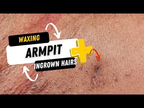 UNDERARM WAXING & BLACKHEAD