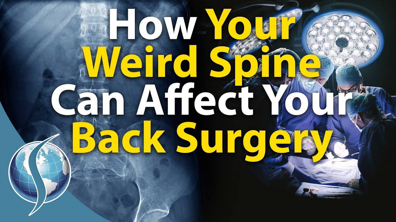How Your Weird Spine can Affect Your Spine Surgery - YouTube