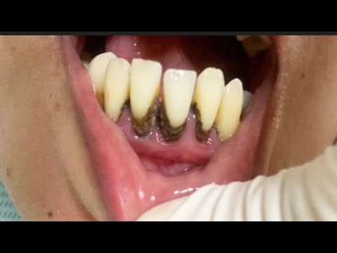 scalling black tartar/ pembersihan karang gigi/ calculus removal - YouTube