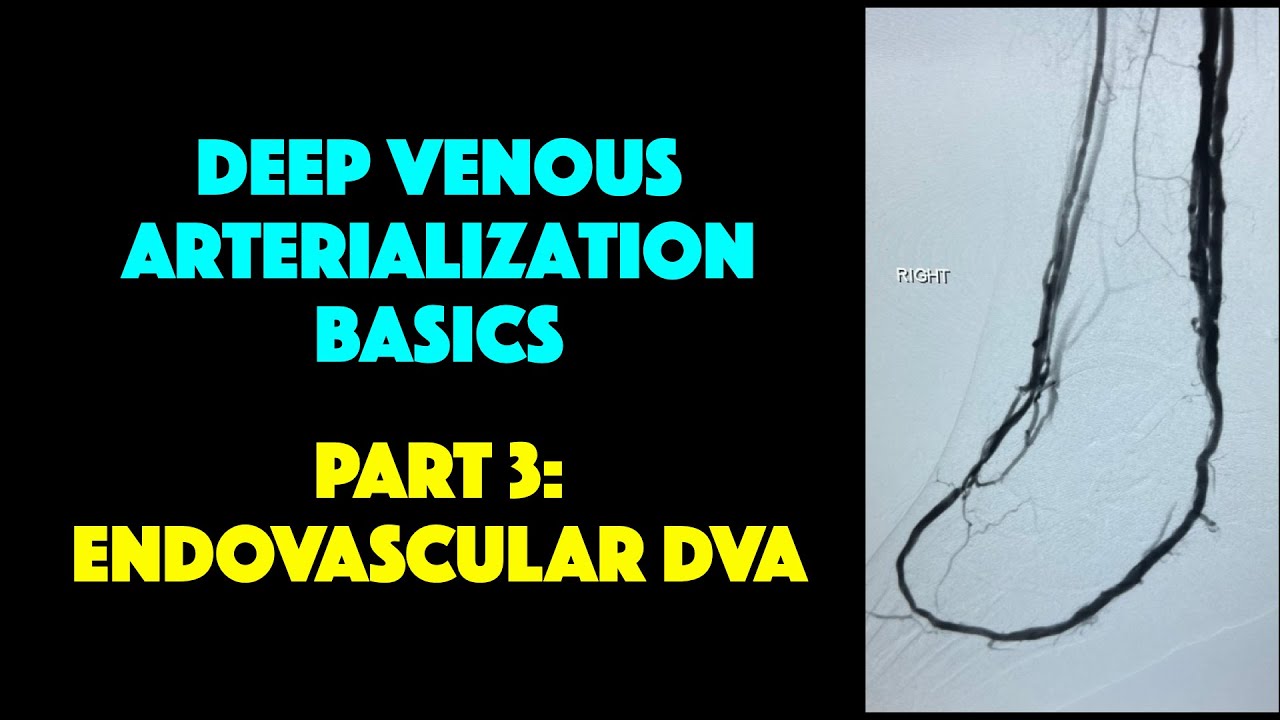 DVA Basics Part 3 of 5: Endovascular DVA (Deep Venous Arterialization ...