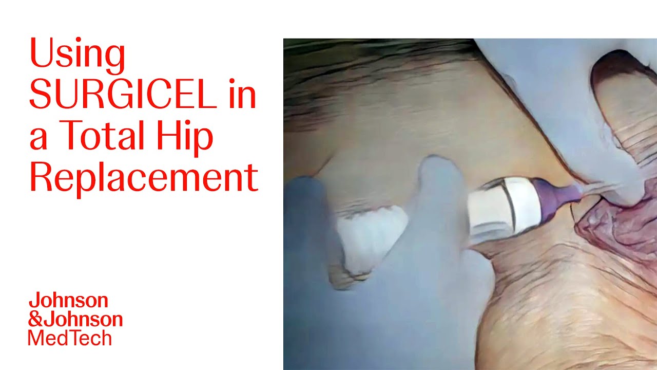 SURGICEL Powder in Action: Surgical Bleeding Management in Total Hip ...