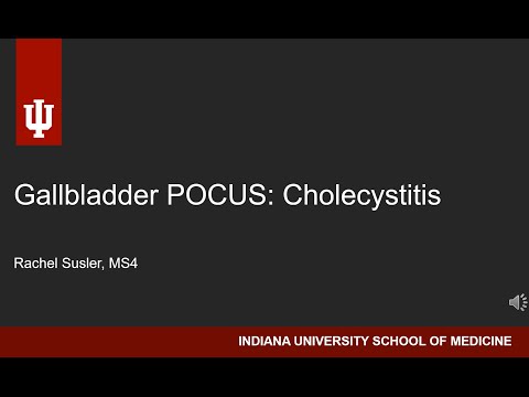 POCUS Gallbladder Cholecystitis video - YouTube