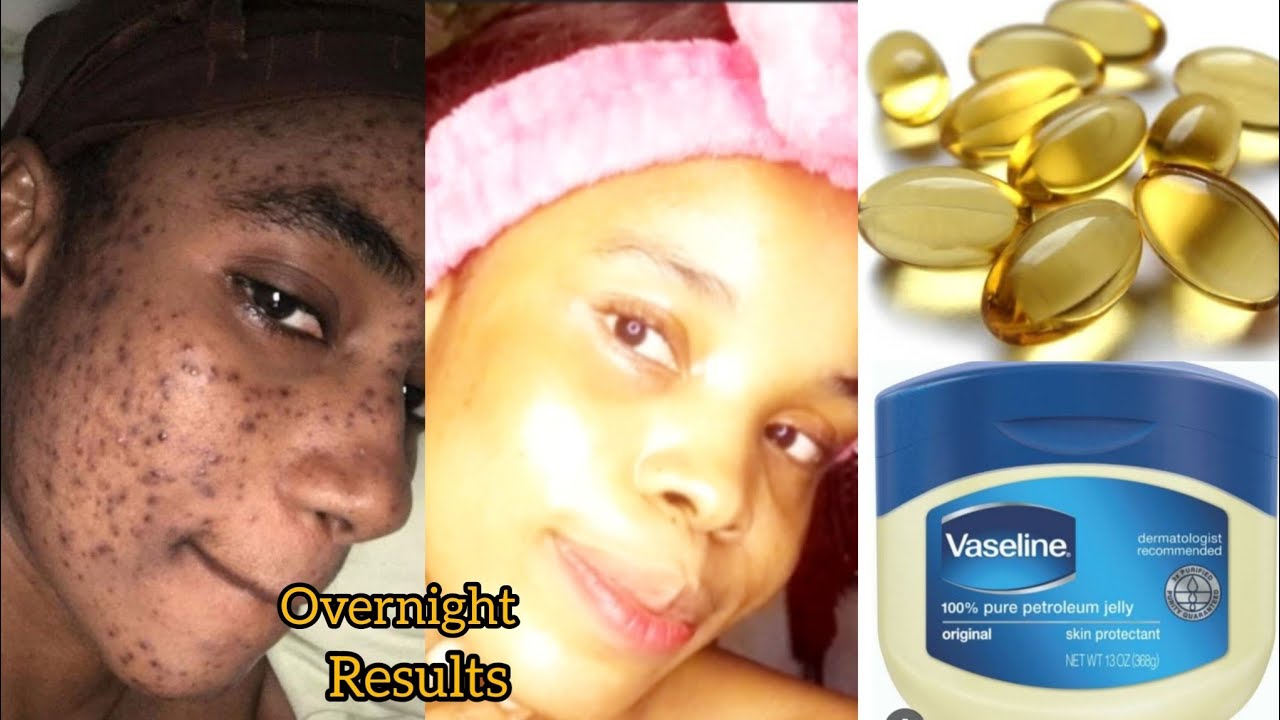 APPLY VASELINE AND COD LIVER OIL ON YOUR FACE AND SEE MAGIC - YouTube