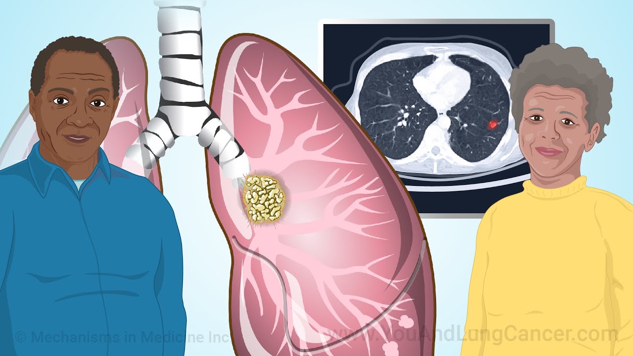 Early Detection and Screening for Lung Cancer in Black Americans - YouTube
