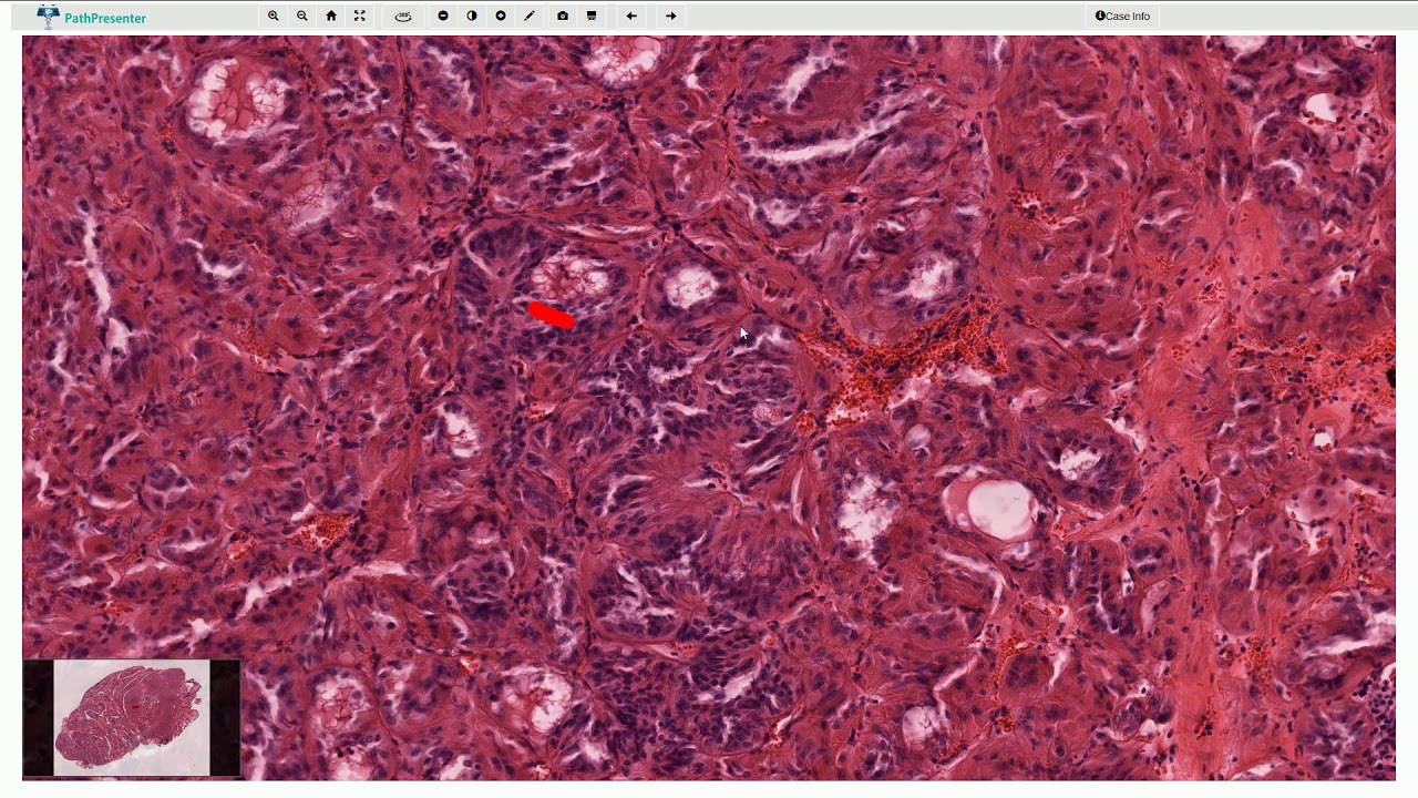 Hyalinizing Trabecular Tumor - Thyroid Gland, Histopathology - YouTube