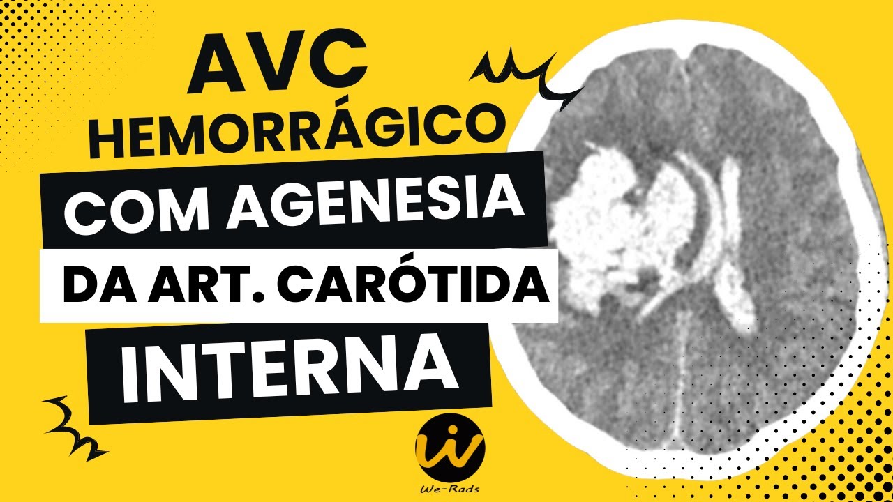 AVC Hemorrágico com Agenesia da Artéria Carótida Interna - YouTube