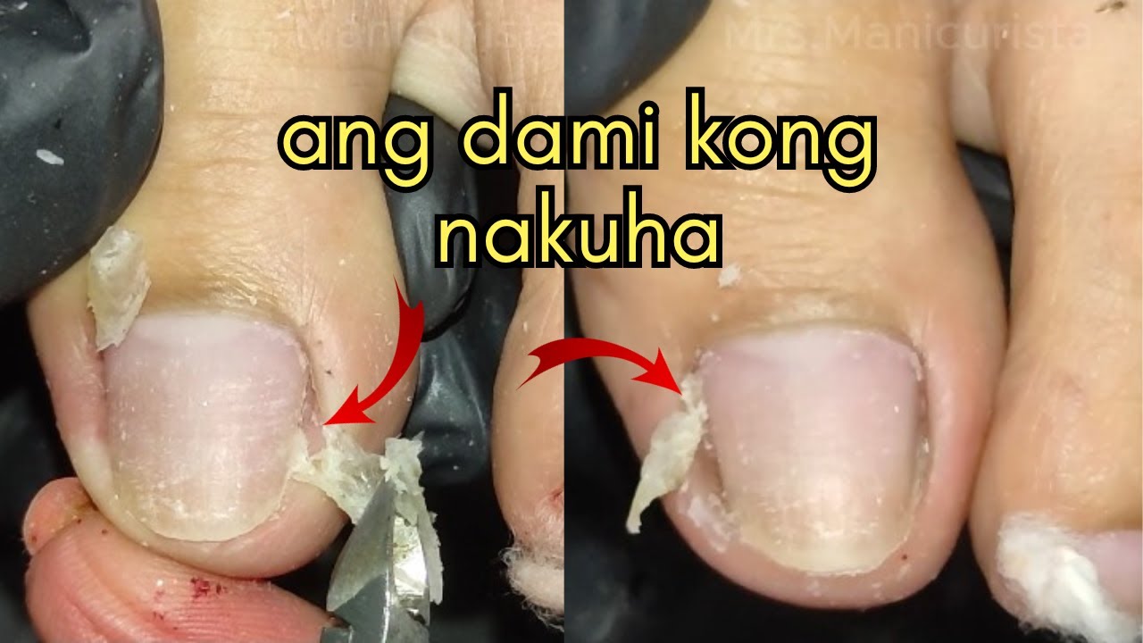 Vlog 988|Dry Skin/Ingrown Removal| PEDICURE 888 - YouTube