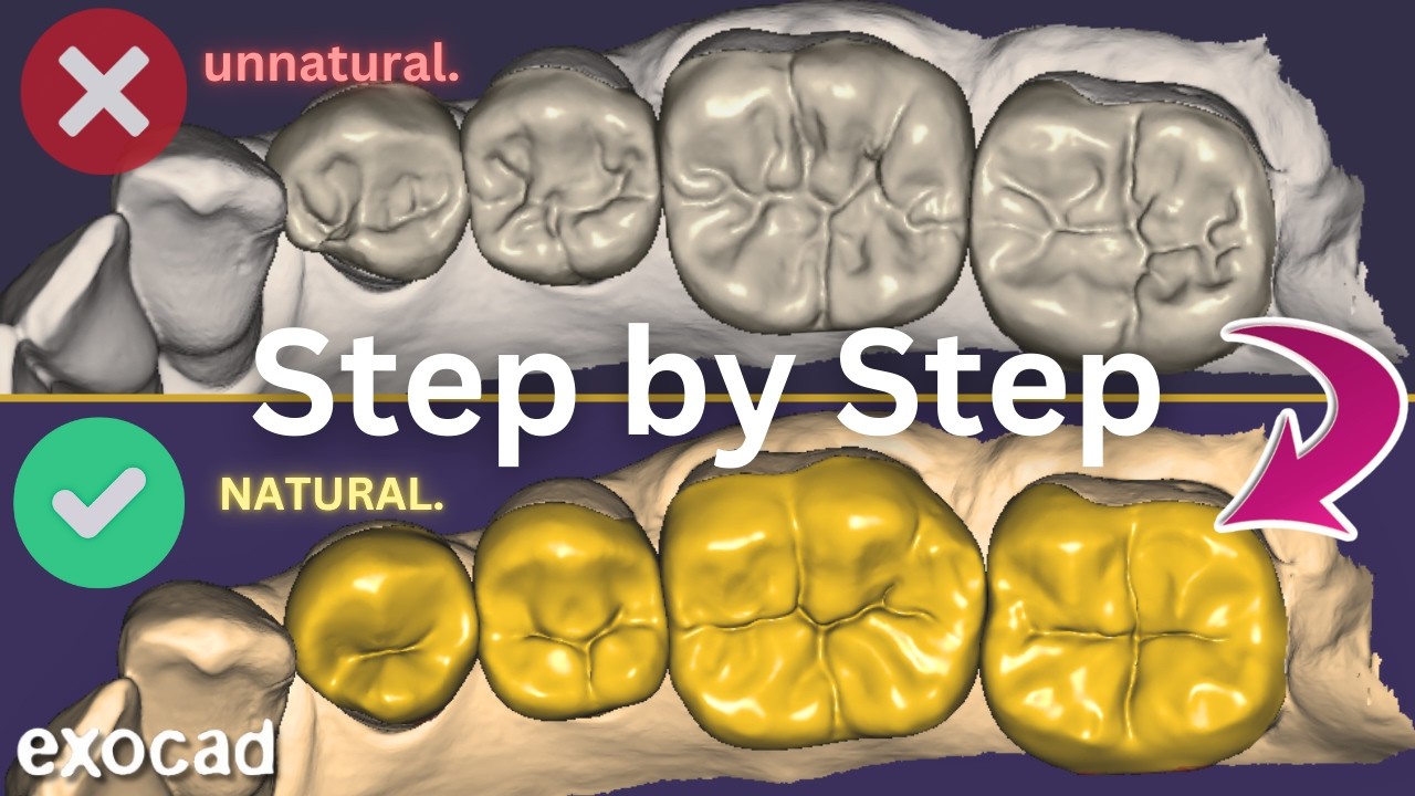 Design ONLAYS Like Mother Nature. 2025 EXOCAD - YouTube