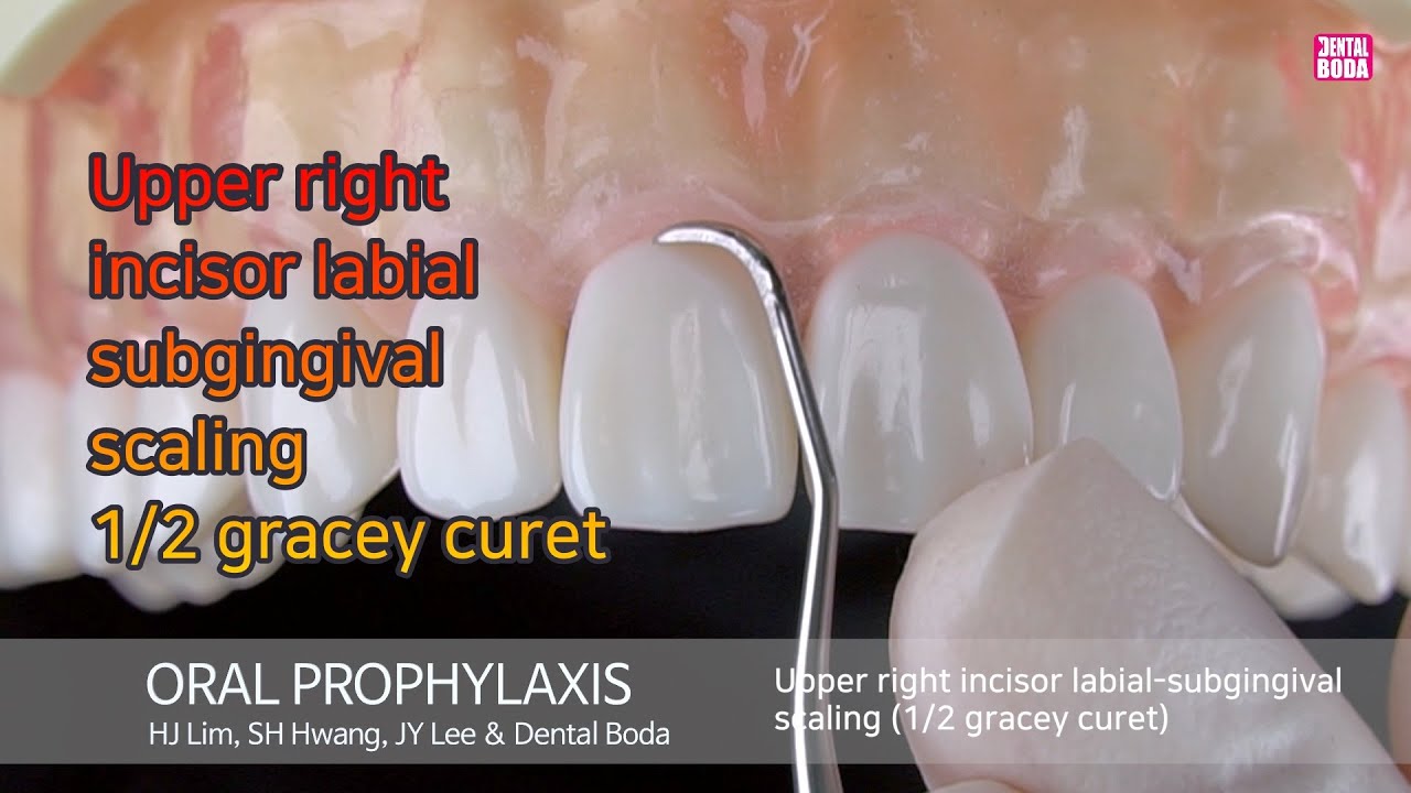 Upper right incisor labial subgingival scaling 1/2 gracey curet - YouTube
