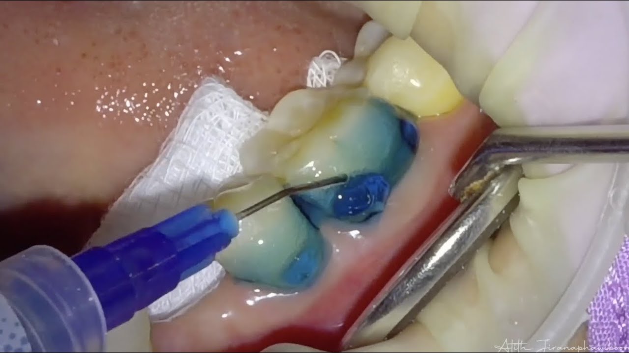 Class V composite filling - YouTube