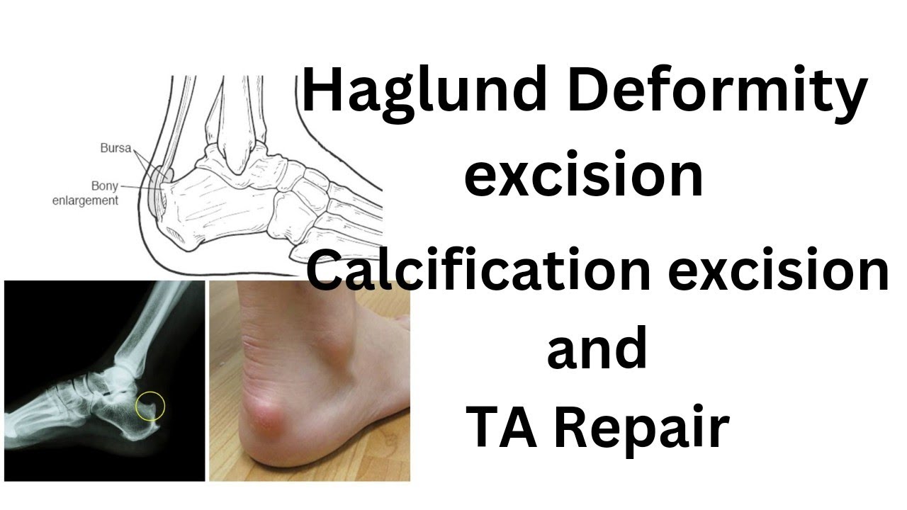 Surgery for Haglund Deformity and calcific tendinitis - YouTube