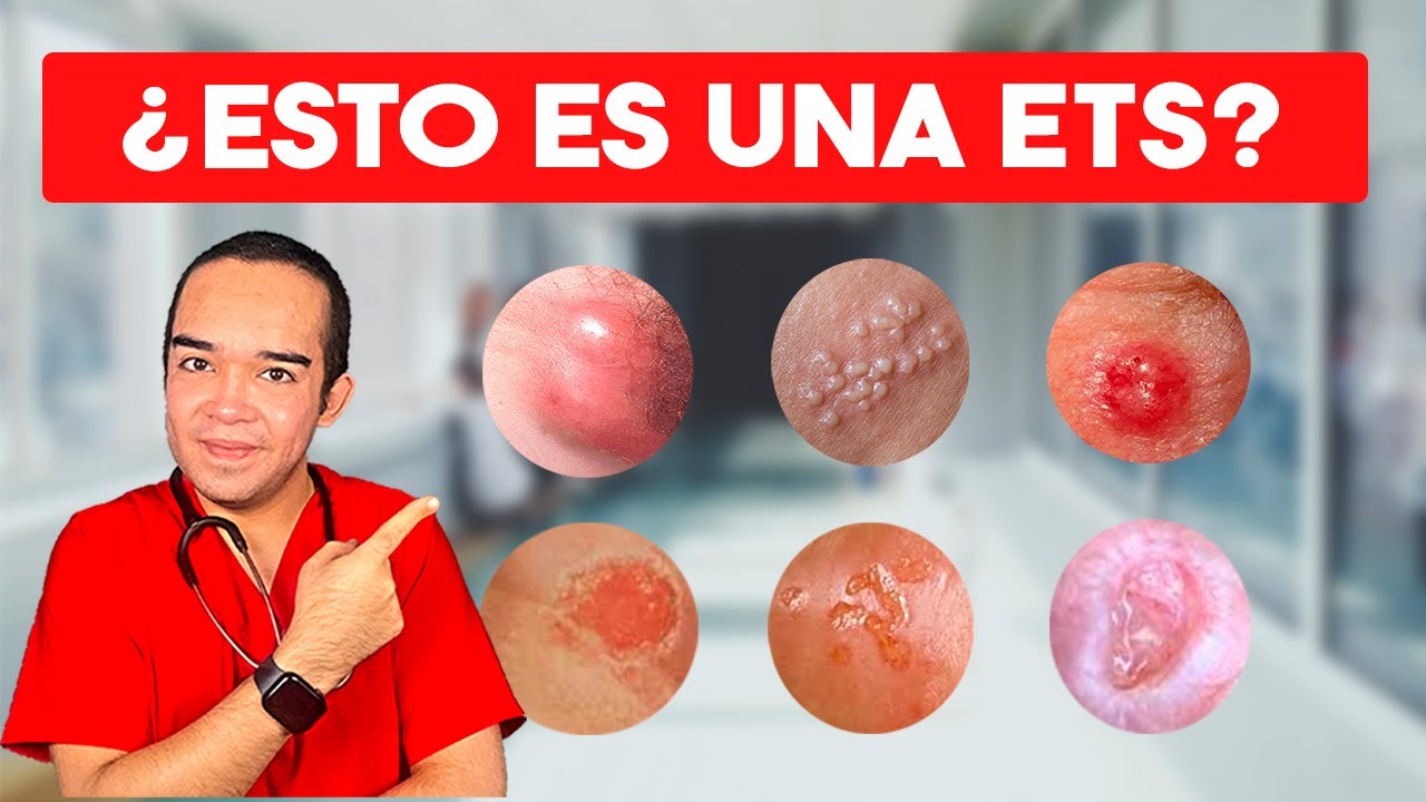 ¿Úlceras genitales? Descubre cuáles son ETS - YouTube