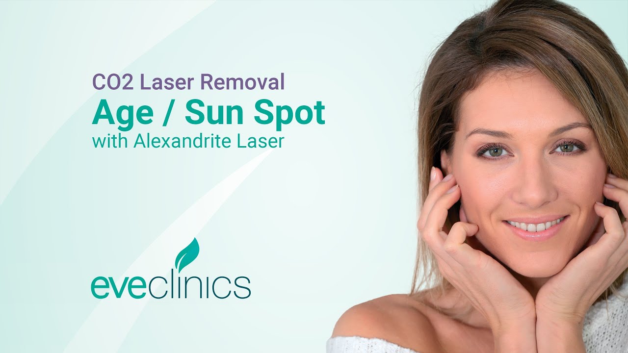 Age / Sun Spot Removal with Alexandrite Laser | Eve Clinics Specialist ...