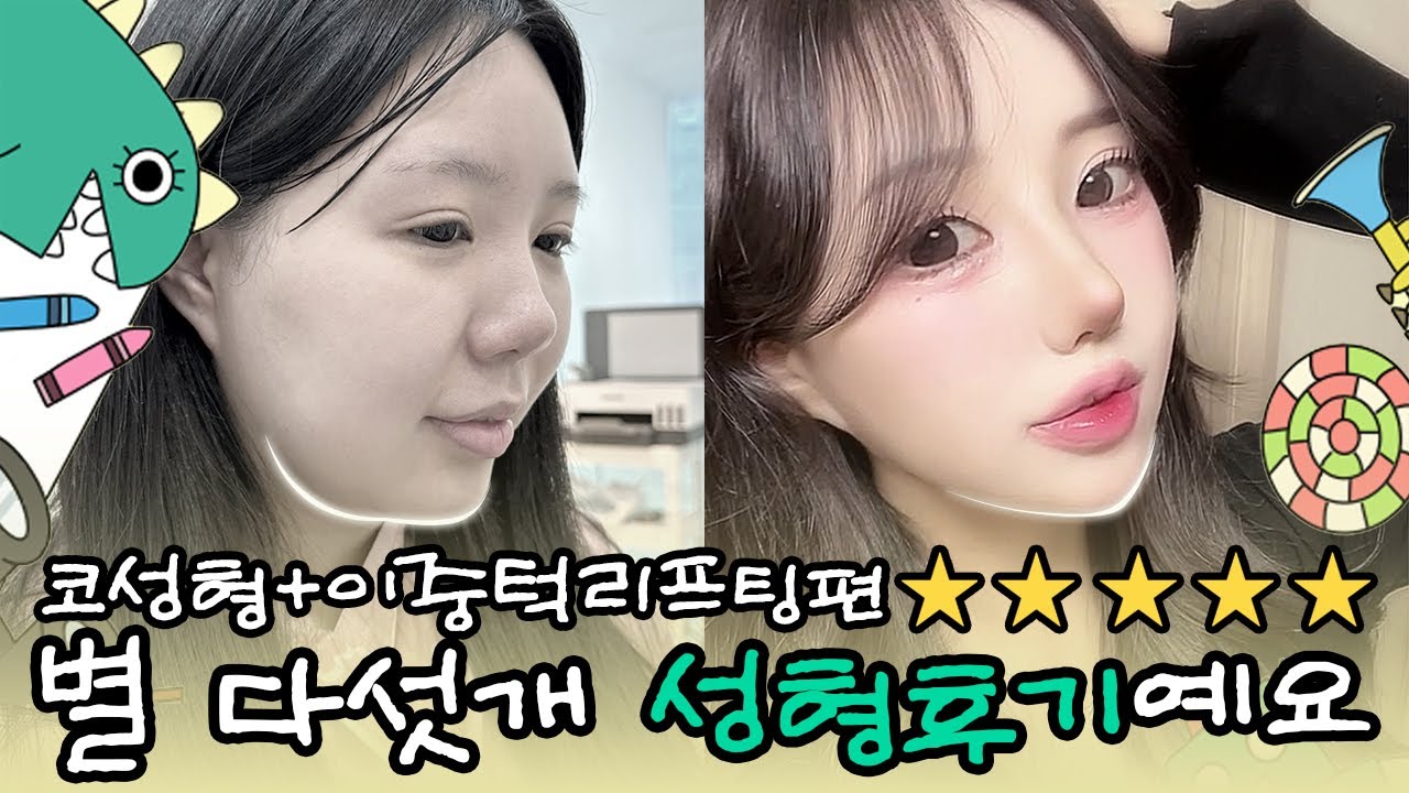 짱구도 반할 이슬이누나급 미모 된 후기♥ 코성형 이중턱리프팅 아큐스컬프 실리프팅 엘라스티꿈 워너비 Vlog 3편