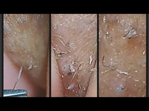 Ingrown Hair Follicle Sheath Pull!! + Deep Ingrown Hair Under Flaky ...